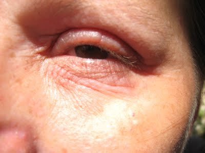 Carrmumble: ACL Mud Rash